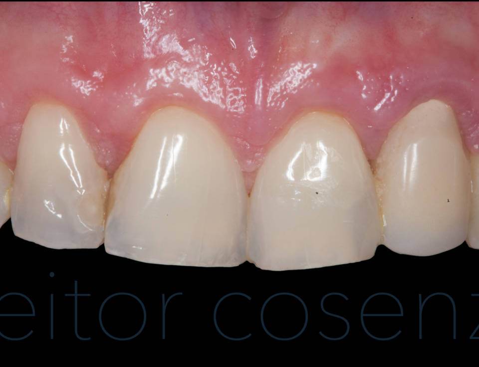 recobrimento radicular Archives - Instituto FRC